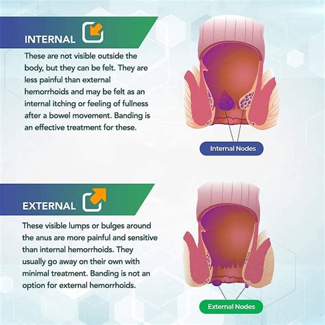 Hemorrhoid And Fissure Cream Hemorrhoid Relief Cream Hemorrhoid Ointment