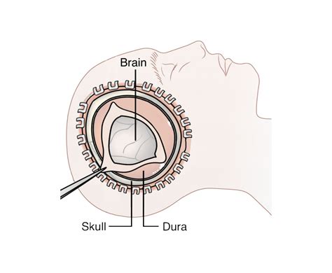 Management Of Severe Tbi Decompressive Craniectomy Resusnation