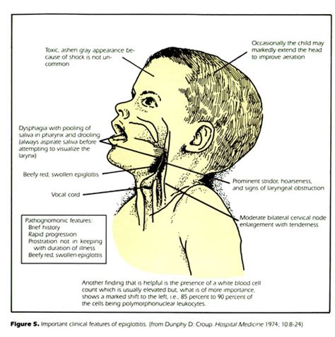 Epiglottitis Tripod