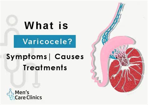 Varicocele Symptoms Causes And Treatment