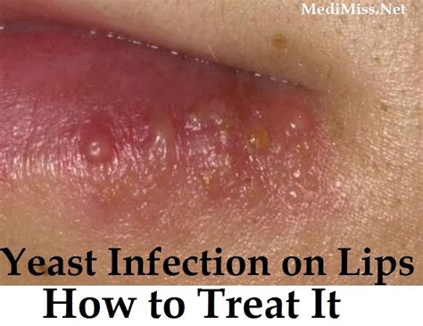 Staph Infection Upper Lip At Douglas Jacobson Blog Staph Infection Upper Lip At Douglas Jacobson Blog