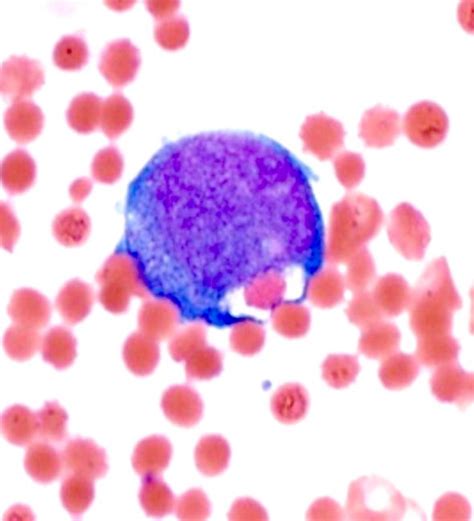 Pathology Outlines Aml With Kat6acrebbp Pathology Outlines Aml With Kat6acrebbp