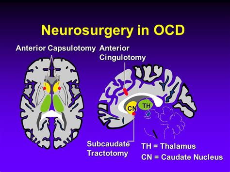 Obsessive Compulsive Disorder Ocd Wayne K Goodman Md Director Division Of Adult