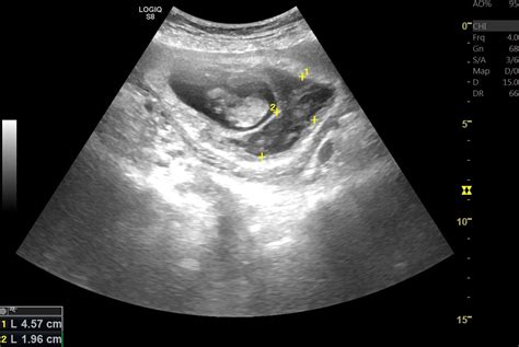 Subchorionic Hemorrhage Image