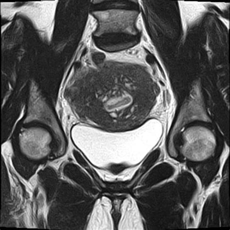 Uterine Adenomyosis Noninvasive Diagnosis Mdedge Obgyn
