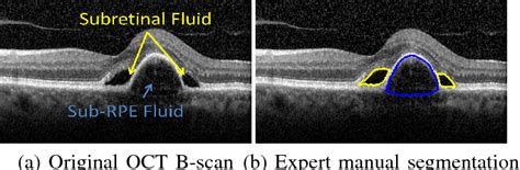 Figure 1 From Automatic Detection Of Subretinal Fluid And Sub Retinal