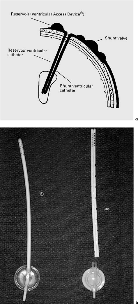 Figure From Evaluation Of Shunt Malfunction Using Shunt Site Reservoir Semantic Scholar