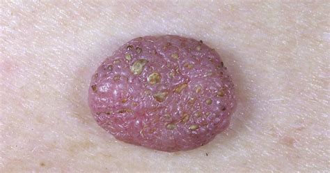 Nevi And Malignant Melanoma Clinical Tree