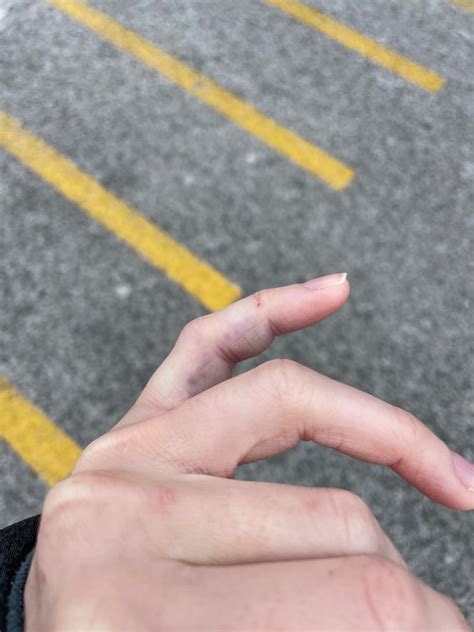 I Fractured My 5th Metacarpal Ive Been In A Cast For 3 Weeks And I