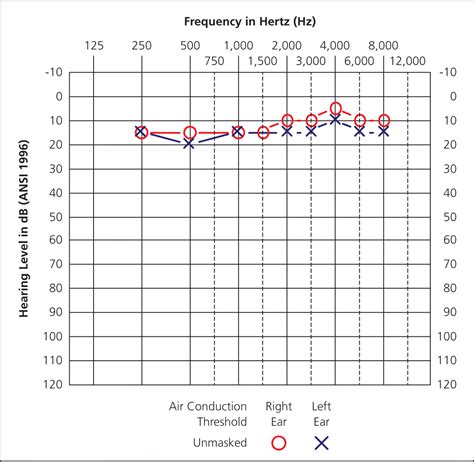 Normal Pure Tone Audiogram