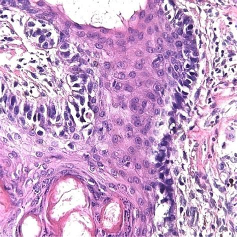 Along The Sheath Of The Hair Follicle The Tumor Cells Expand