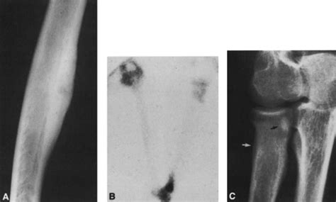Bone Tumors And Related Condition Radiology Key