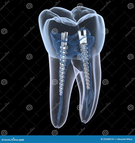 Dental Steel Post Inside Molar Teeth Xray View Dental Endodontic
