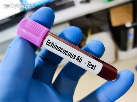 Echinococcus Antibody Test 이미지 1788770808 게티이미지뱅크