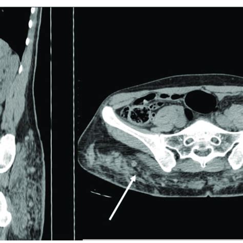 Ct Appearance Of Necrotizing Fasciitis In A 58 Year Old Woman With A Download Scientific