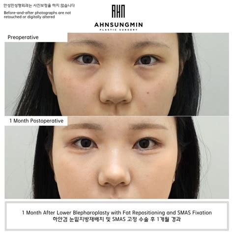 Natural Lower Blepharoplasty Korea Aegyo Sal