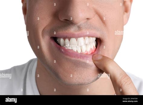 Man Showing Inflamed Gums On White Background Closeup Stock Photo Alamy