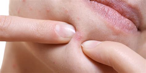 Can Exercise Cause Acne Dermatologist Tips To Prevent Acne Caused By