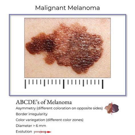 Clinical Pathology Glossary Malignant Melanoma Ditki Medical