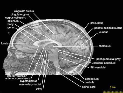 Hippocampus Mri Sagittal