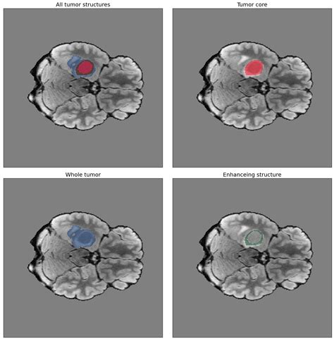 multimodal 3d brain tumor segmentation with azure ml and monai