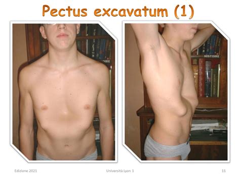 Petto Concavo Femminile