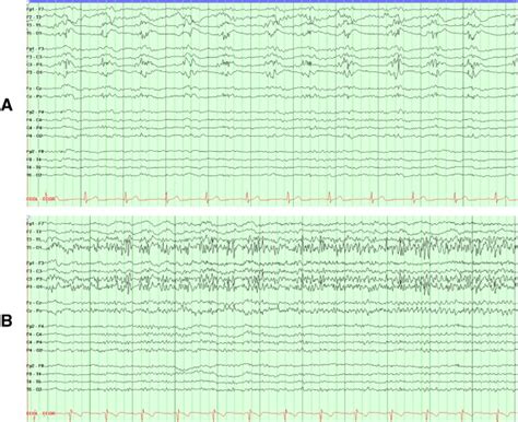 Continuous Lateralized Periodic Discharges With Overlying Fast Activity