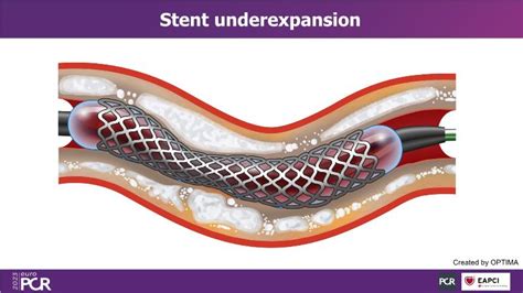 3dstent A New Era In Stent Enhancement