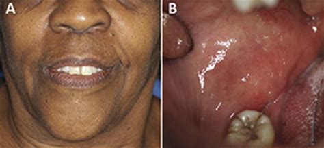 Reply To The Letter To The Editor Comments In Relation To The Cpc Case Entitled “submucosal