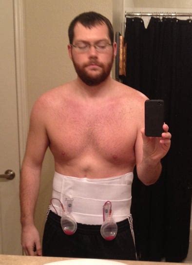 Xiphoid Process Protrusion Sternum Anatomy And Labeled Diagram