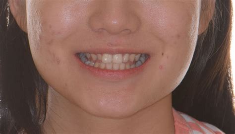 Overbite Central Orthodontics