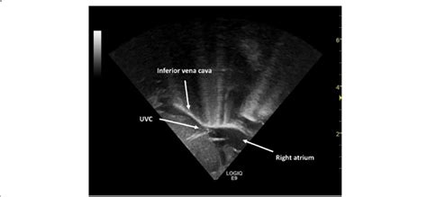 Ultrasound Scan Of The Correct Uvc Tip Position At The Junction Of