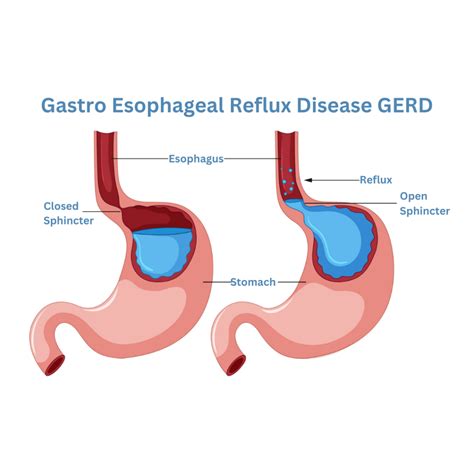 Gerd Surgery Dr Digant Pathak