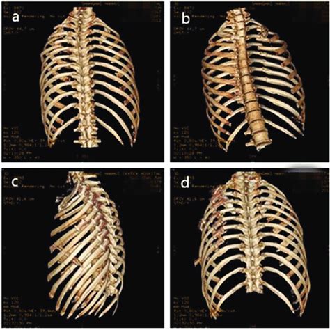 Rib Fracture Before And After The Operation A B Broken Rib Before