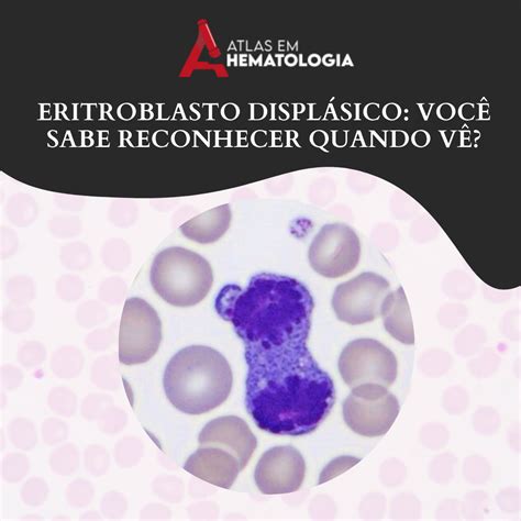 Eritroblasto Displásico Você Sabe Reconhecer Quando Vê Atlas Em