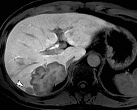 Imaging Diagnosis Of Intrahepatic And Perihilar Cholangiocarcinoma Recent Advances And
