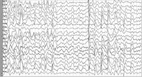 Eeg Before Implantation Of Vns Eeg Findings Showed Interictal