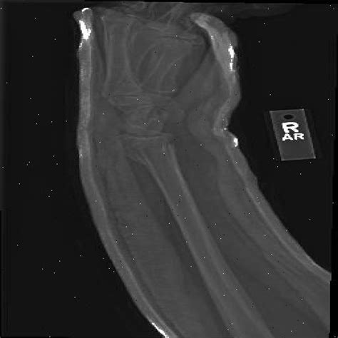Xray Fracture Object Detection Model V1 2024 01 18 11 30am By Wkspaceone
