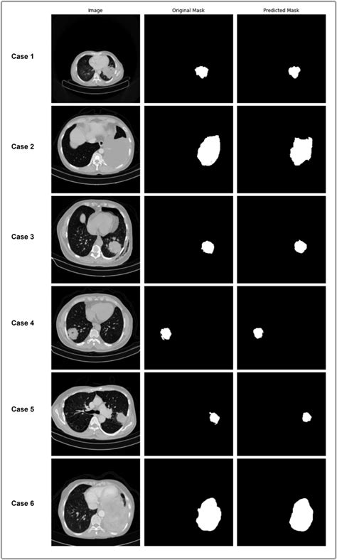 Segmentation Results For Medium And Large Size Lung Tumors A Download Scientific Diagram