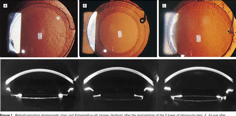 Intraocular Lens Capsule Opacification At Oscar Nimmo Blog