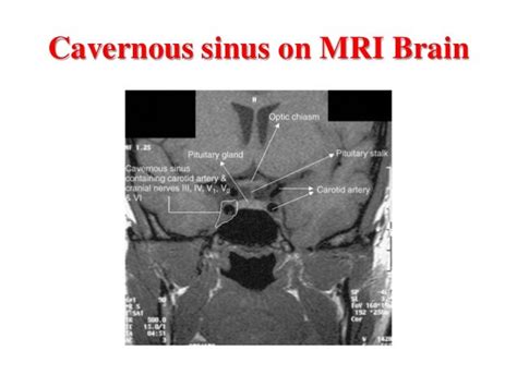 Cavernous Sinus Thrombosis Pdf Ppt