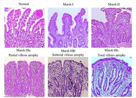 What Does A Celiac Endoscopy Look Like R Celiac