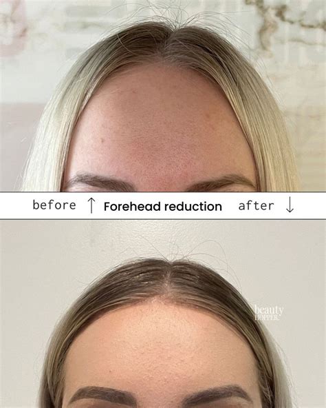 Forehead Reduction Before And After Forehead Reduction Plastic