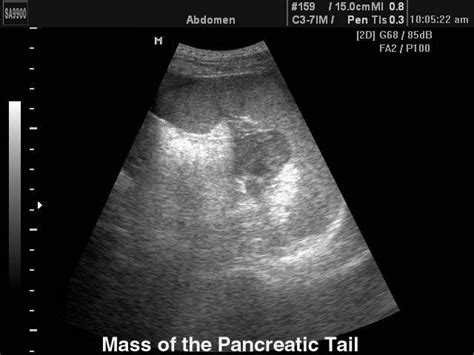 Ultrasound Pancreatic Tail Mass B Mode Echogramm №148