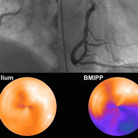 A Schema Of The Hypothesis For The Prevention Of Reperfusion Induced Download Scientific