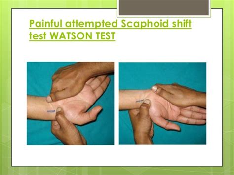 Scaphoid Fractures