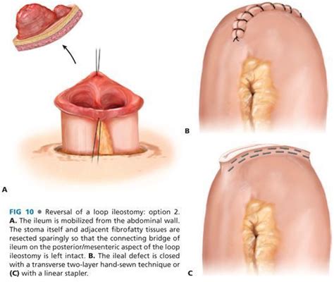 End And Diverting Loop Ileostomies Creation And Reversal Abdominal Key