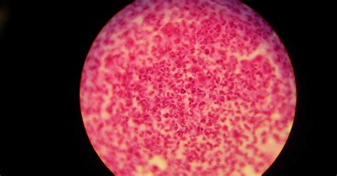 Alerta Por Un Caso De Supergonorrea En Austria Infobae