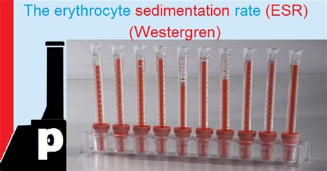 Erythrocyte Sedimentation Rate Westergren Tube مدونة إنسان للعلوم والتكنولوجيا