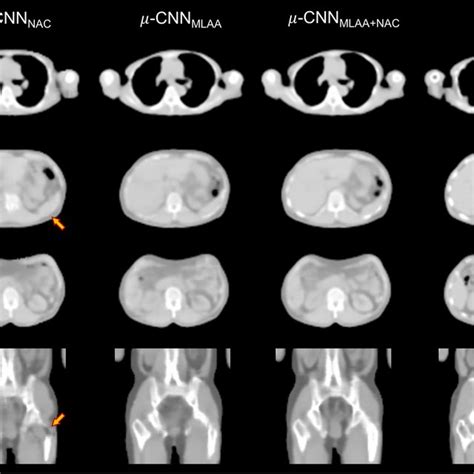μ maps generated using different cnn inputs transaxial slices from